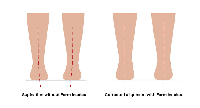 Supination – Form Insoles
